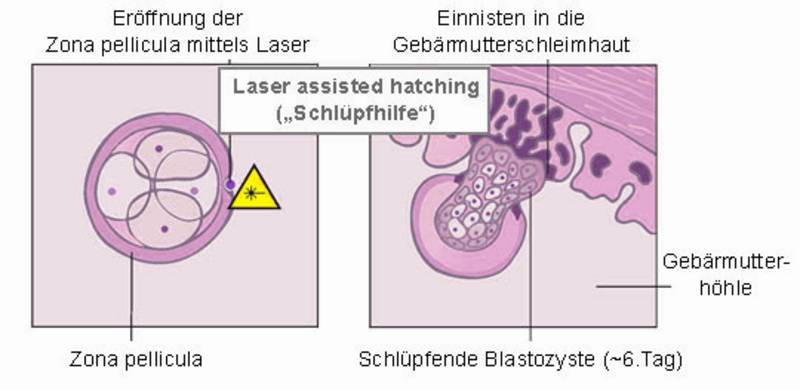 Assisted Hatching-Behandlung | Kinderwunsch Trier